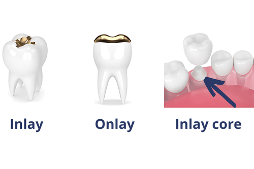 Inlay-core : rôle, pose, prix, remboursement et alternatives