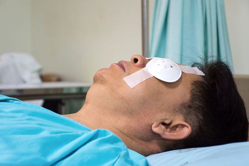 How Long to Wear an Eye Shield at Night After Cataract Surgery