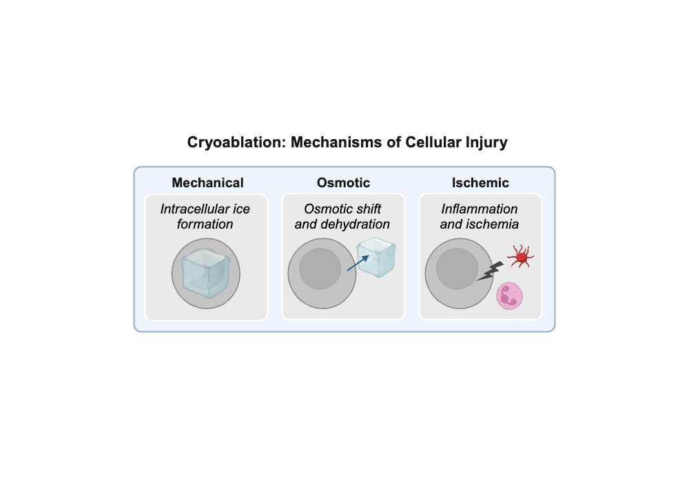 Cryoablation: Mechanisms of Cellular Injury | BioRender Science Templates