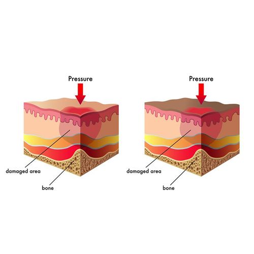 Identifying and managing a stage 1 pressure ulcer in nursing homes