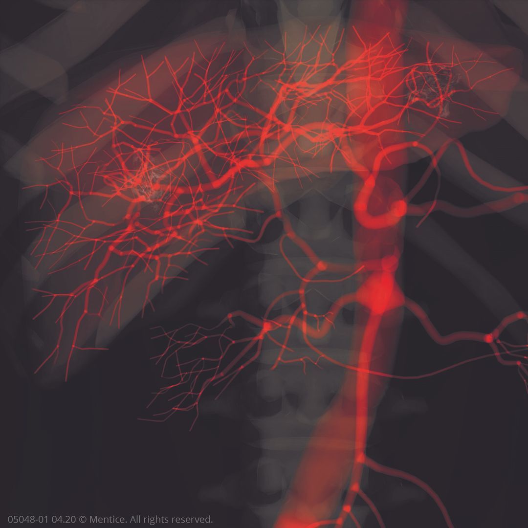 Virtual Reality endovascular simulators