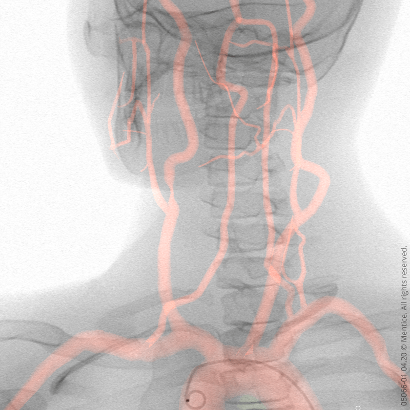 Virtual Reality endovascular simulators