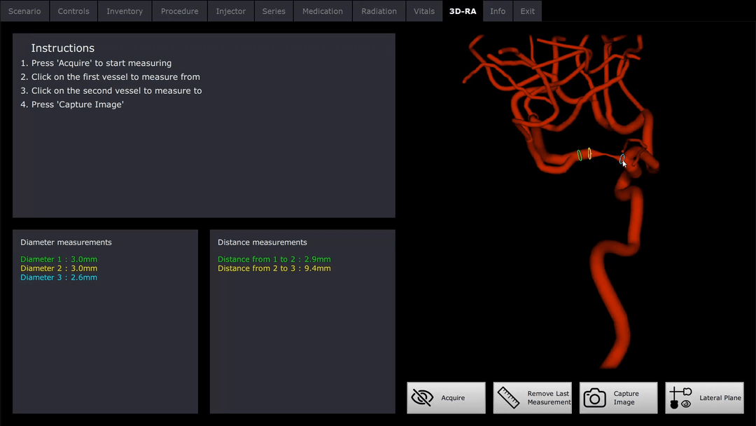 Intracranial Artery Stenosis (ICAD) | Software | Mentice