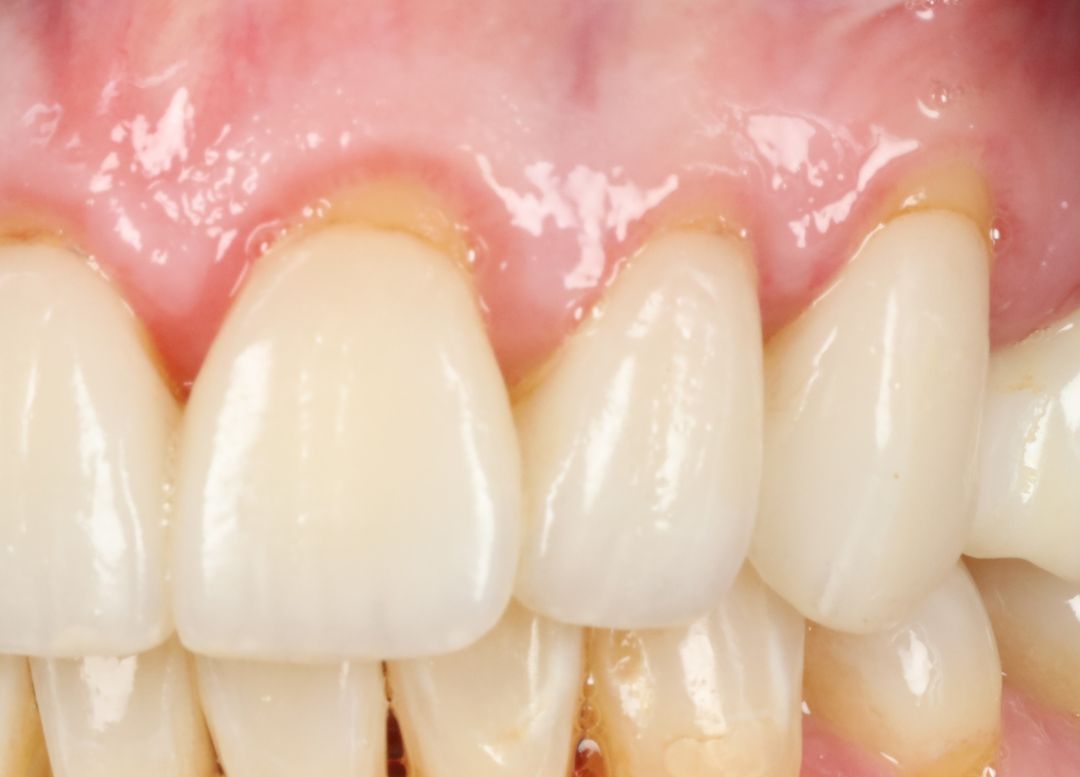 Are You Brushing Too Hard? The Hidden Cause of Gum Recession | Eck ...