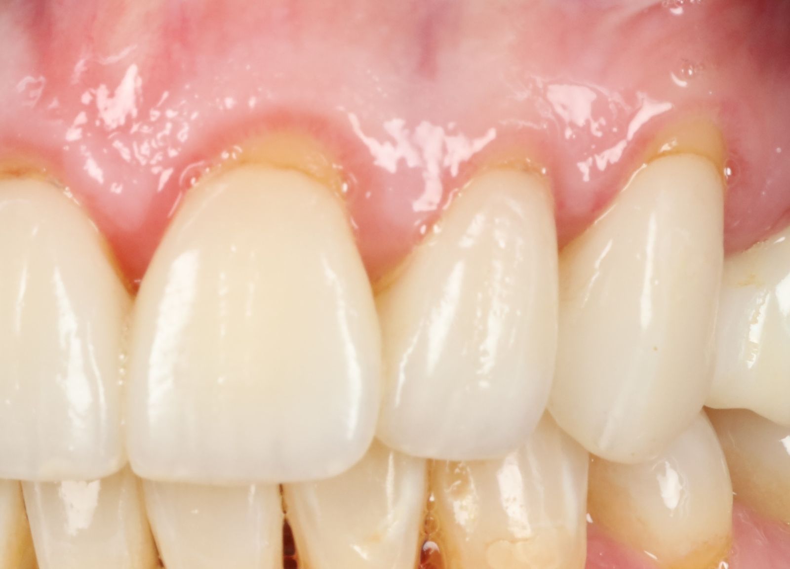 Are You Brushing Too Hard? The Hidden Cause of Gum Recession | Strahler ...
