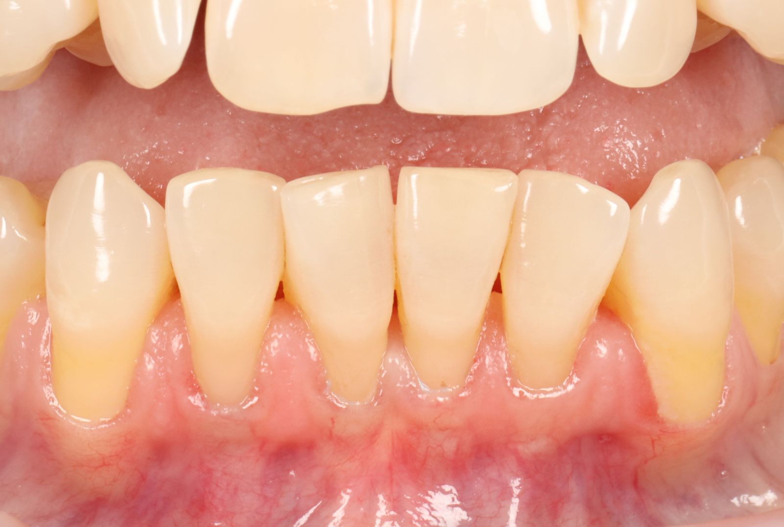 Are You Brushing Too Hard? The Hidden Cause of Gum Recession | Eck ...