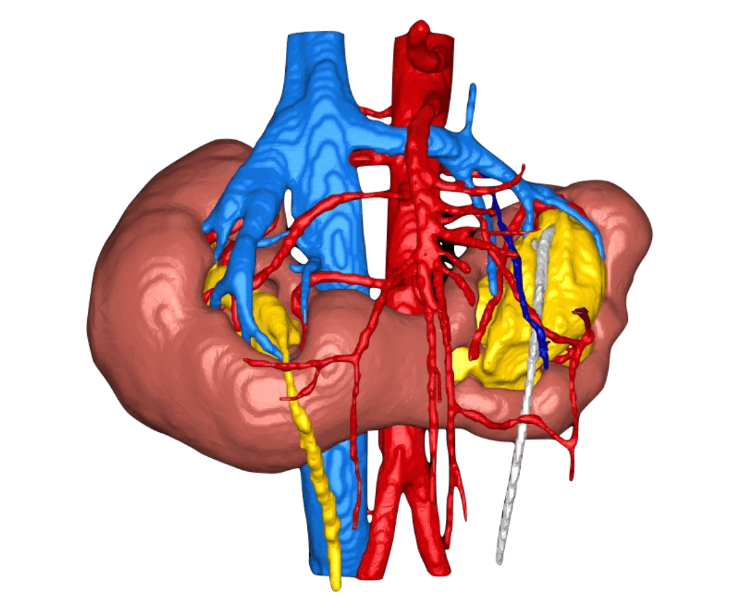 Innersightlabs | Interactive 3D model for pre-operative planning and ...