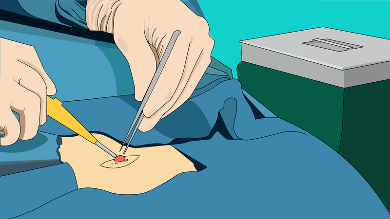 Coverself | Excision of Skin Lesions: Coding Guidelines