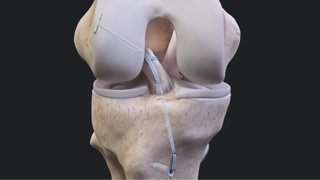 ACL Repair | Arthrex Knee Preservation