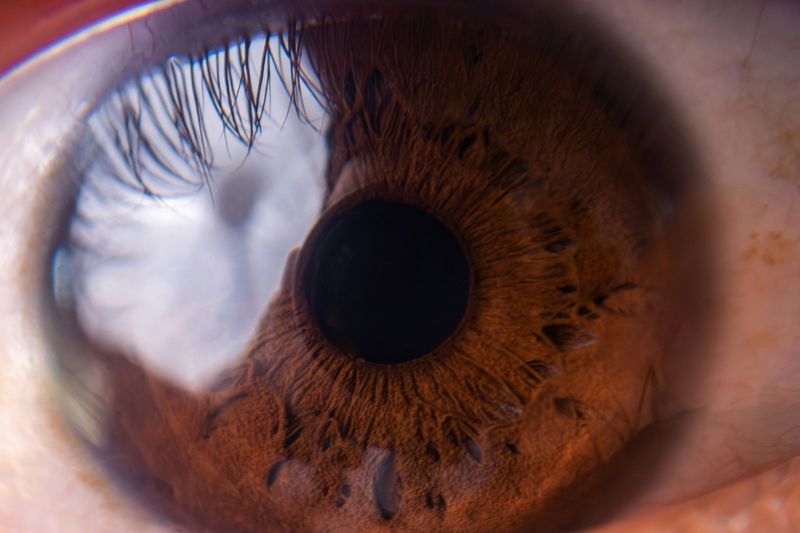 What Is Posterior Capsular Opacification After Cataract Surgery? | West ...