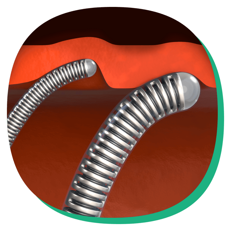 Aristotle Colossus | Scientia Vascular