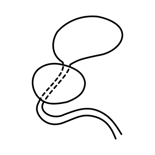 PRIMR | Decipher Prostate Genomic Test - Patient Video