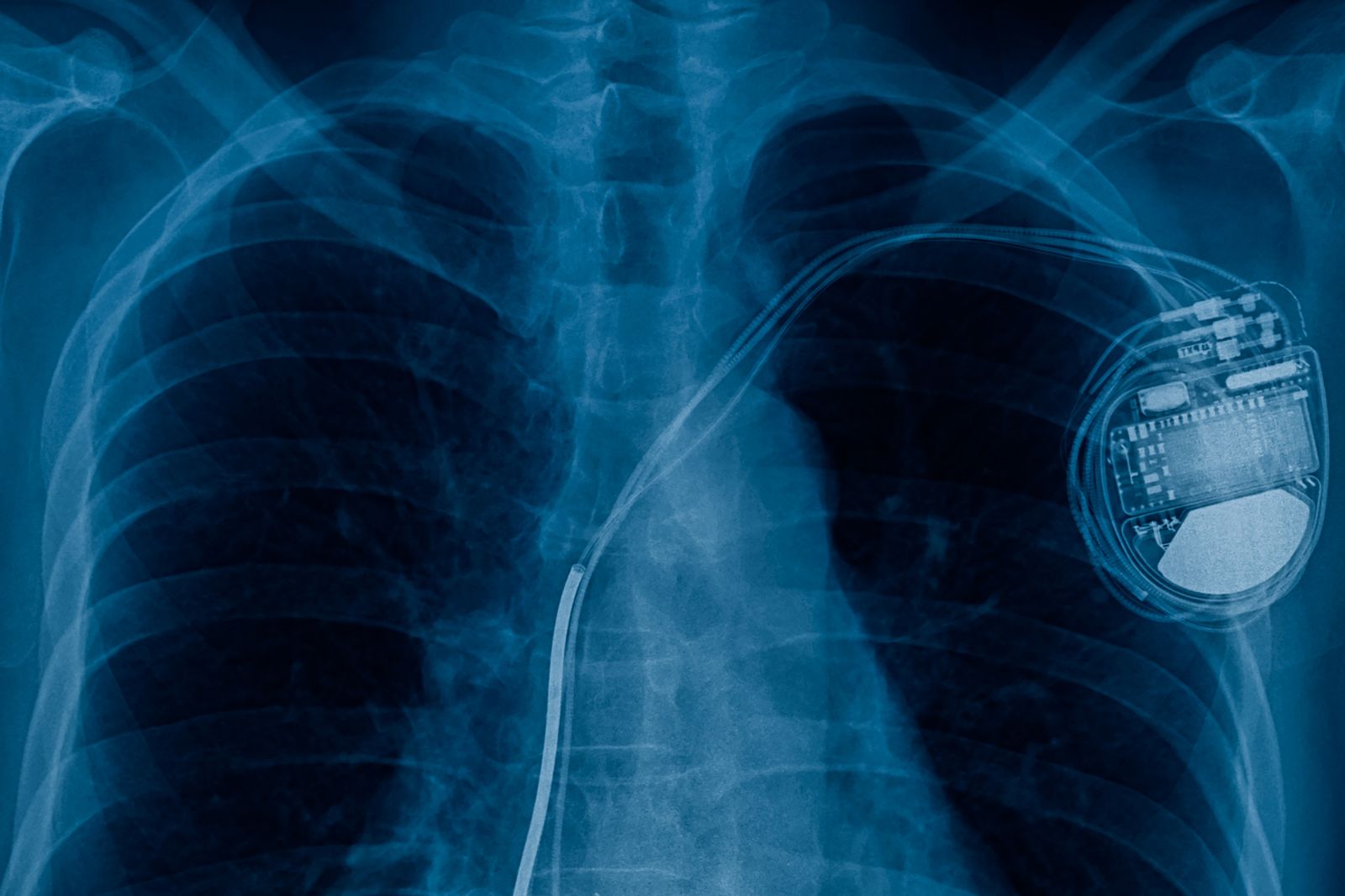 Can I Have an MRI with a Pacemaker? - Ezra