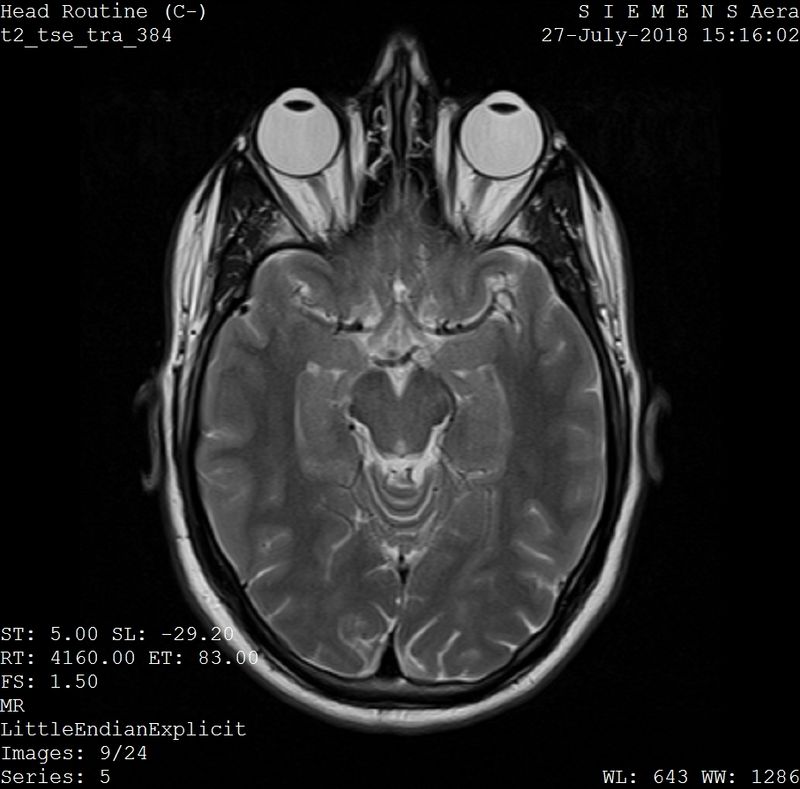 Exploring Brain and Orbit MRI Scans: A Comprehensive Guide - Ezra