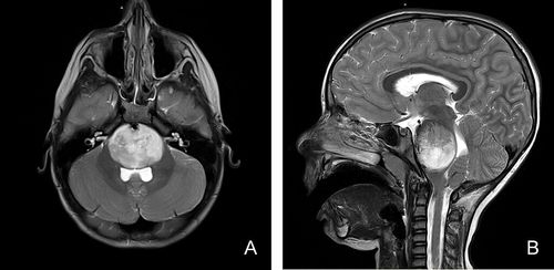 Is Gadolinium Contrast Safe? What the Research Says — and Side-Effects ...