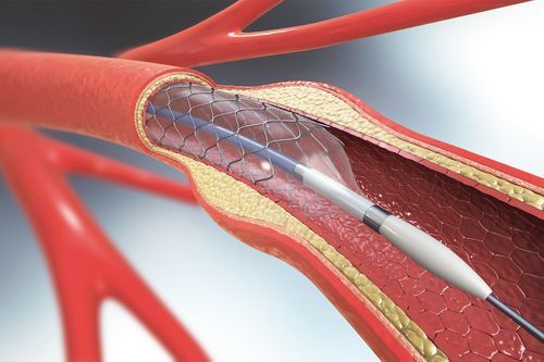 Heart Stent Recovery Time: All To Know | Carda Health