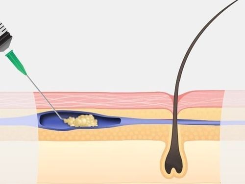 Dr Newmans Clinic | Thread vein removal specialists