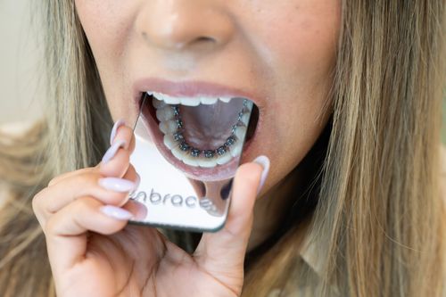 Invisalign Versus Angel Aligner | Life Orthodontics
