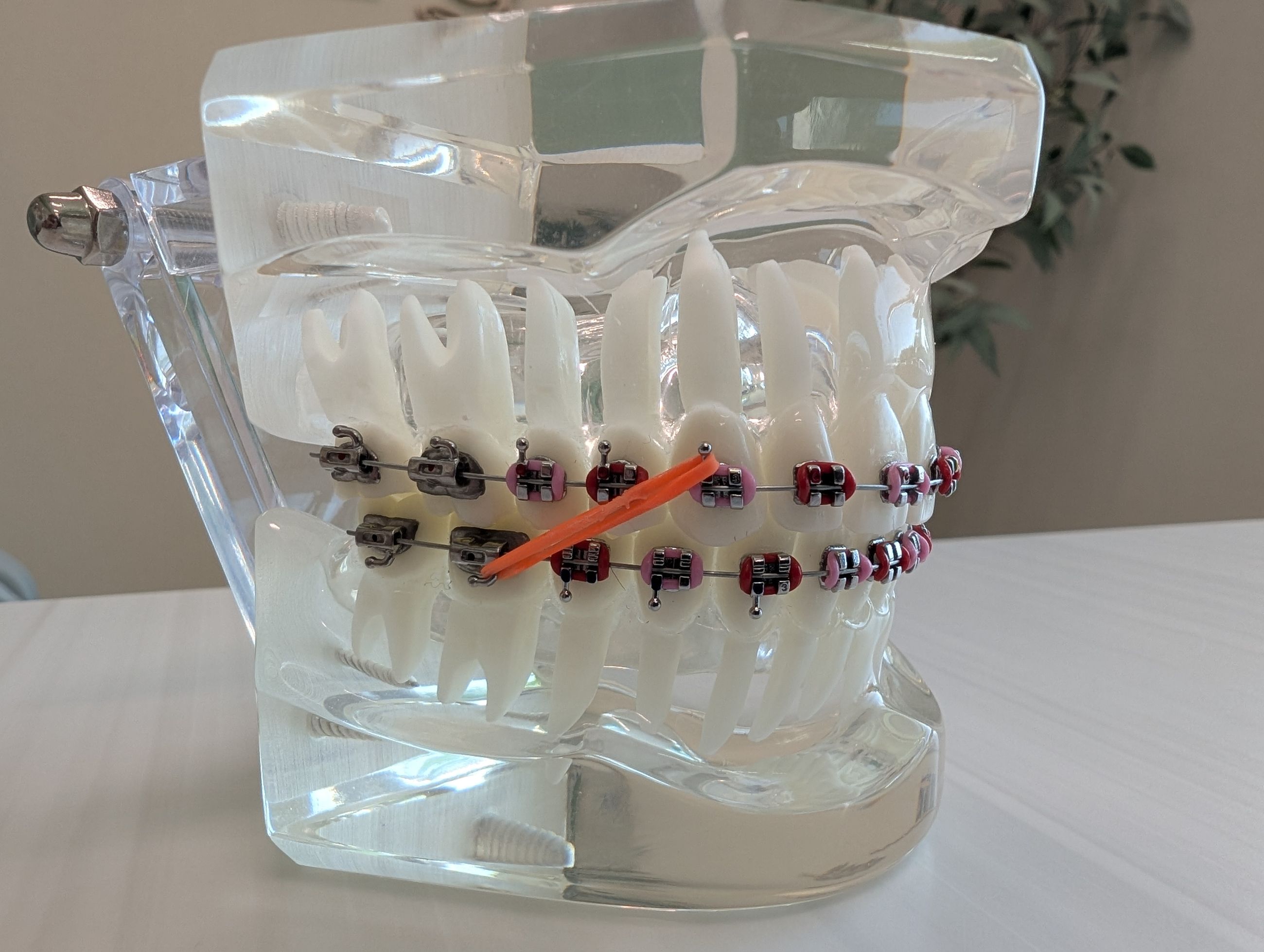 InBrace Technology is Back as InSmile Braces | Life Orthodontics
