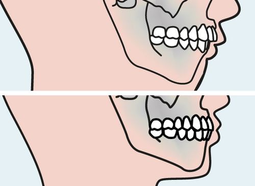 Clear Aligner Treatment Planning: A Guide to Dental Success