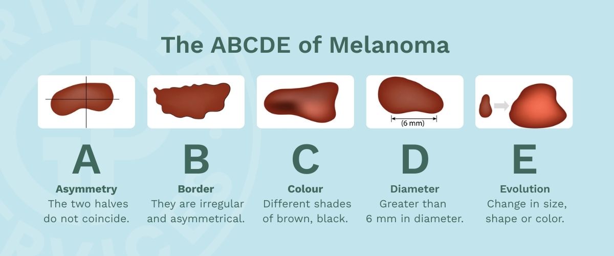 Mole Health Check: Warning Signs & Early Detection of Melano