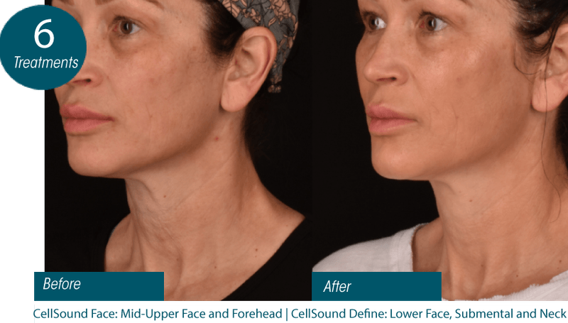 CellSound Aesthetics® | Anti-Aging & Contouring