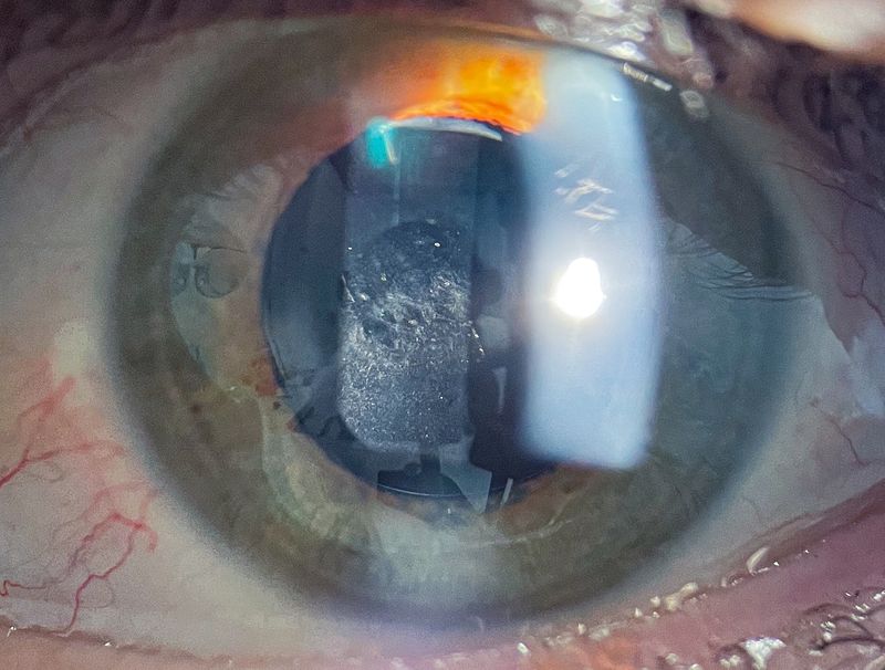 YAG-Kapsulotomie bei Nachstar | EyeZurich