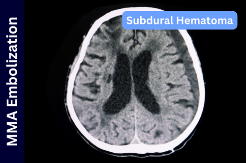 A New Approach to Chronic Subdural Hematomas: MMA Embolization I ...