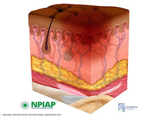Pressure Ulcer Management | iQ Medical | Effective Strategies and Solutions