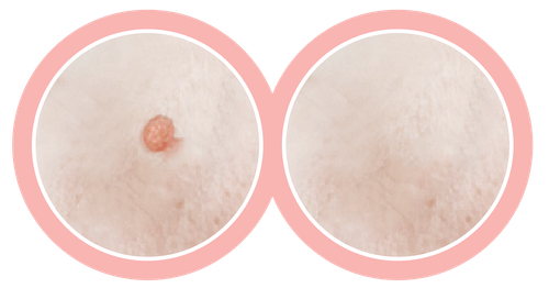 DR THEISS | ClinSkin Fibrocontrol