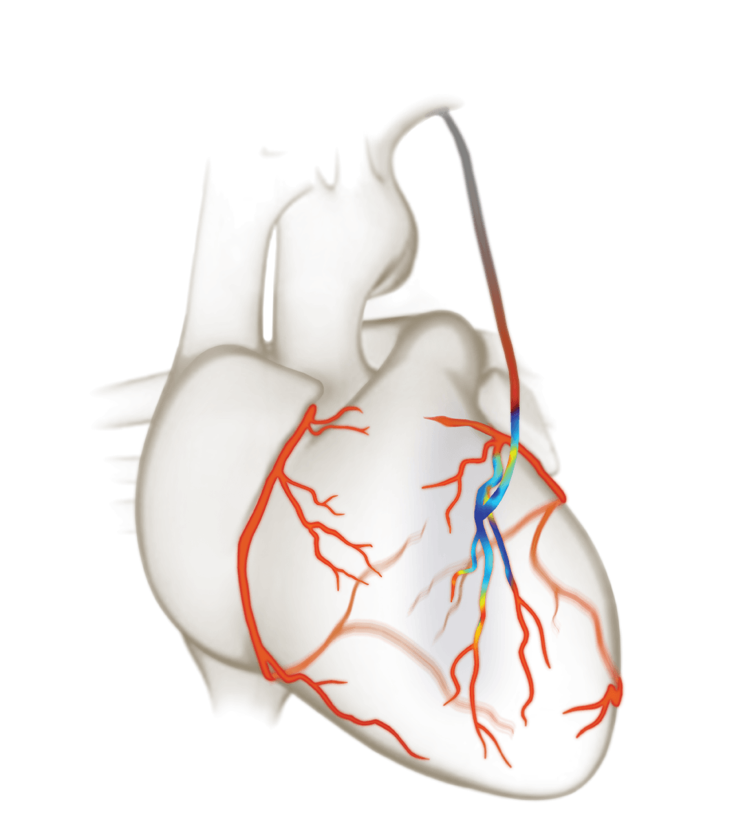 Medistim: Pioneers of TTFM Transit Time Flow Measurement Technology