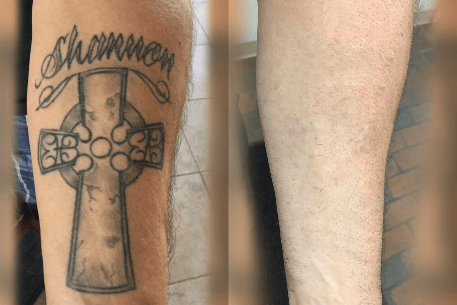 TakeTatt Tattoo Removal - Affordable, safe & effective tattoo removal