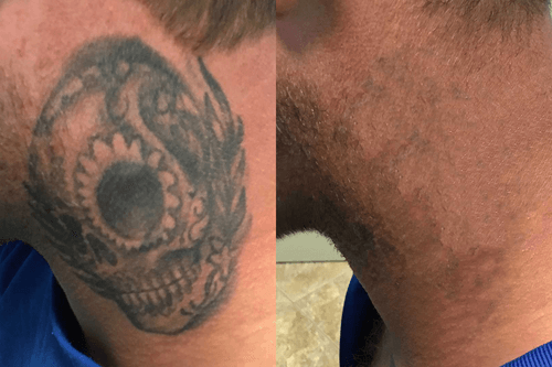 TakeTatt Tattoo Removal - Affordable, safe & effective tattoo removal