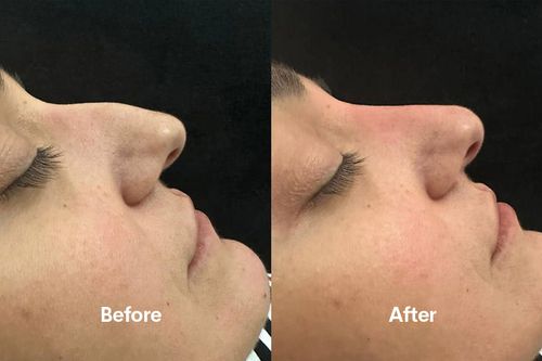 Non Surgical Nose Job | Non Surgical Rhinoplasty – Dr Ash Labib