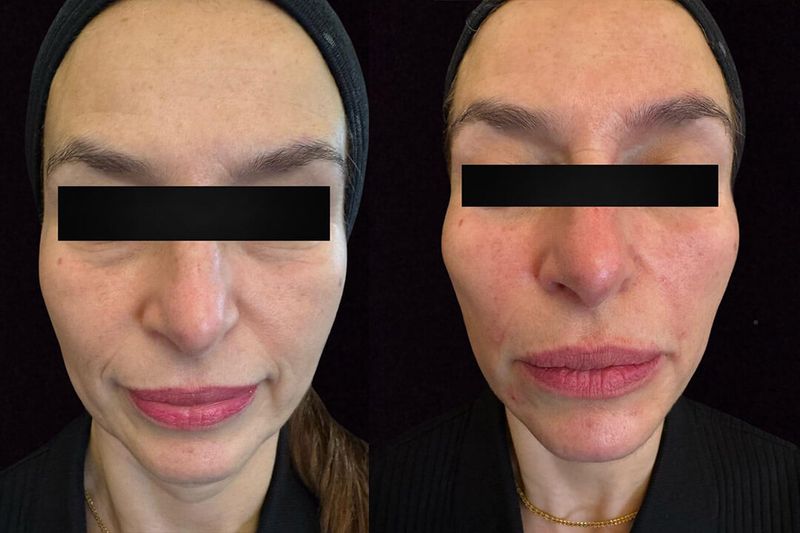 8 Point Facelift | Non Surgical Face Lift Cost – AL Aesthetics