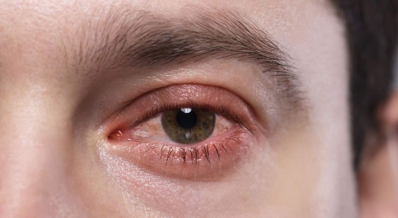 Alcoholic Eyes: Recognizing the Signs and Healing Through Recovery