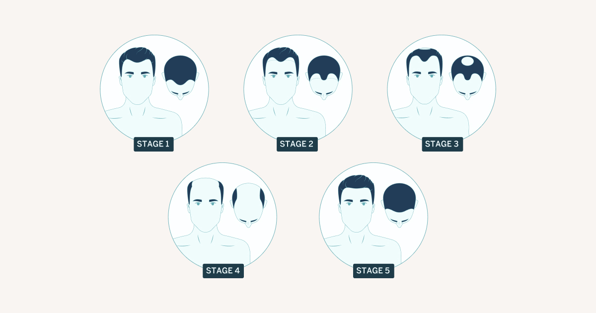 A Solution at Every Stage of Hair Loss | Happy Head