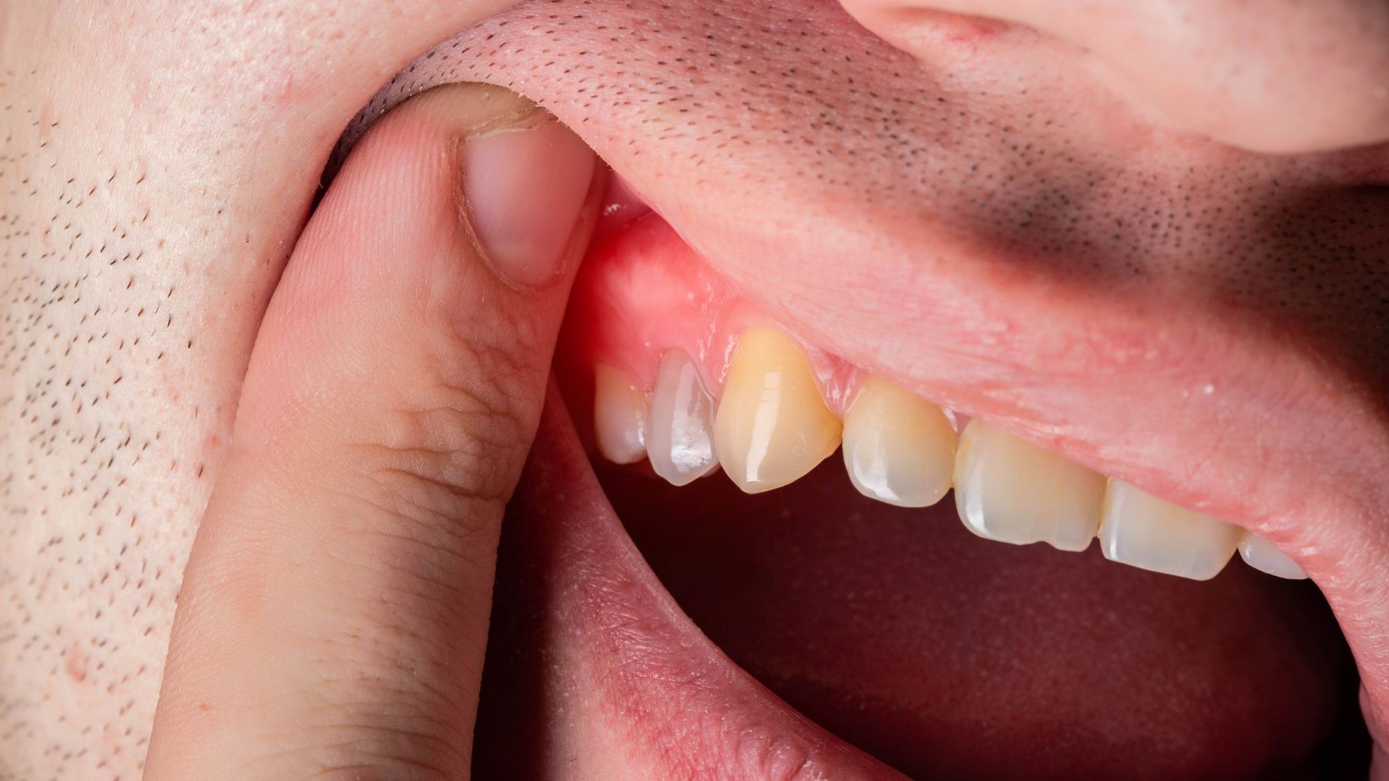 Gencive gonflée : causes, traitements et signes d’alerte
