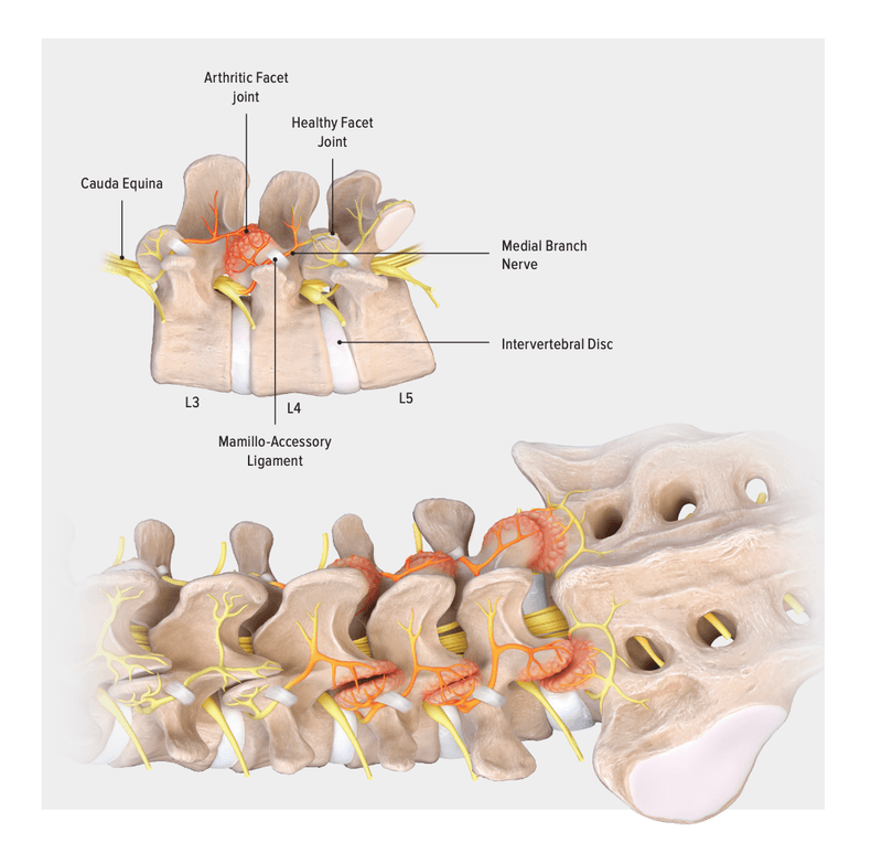 Endoscopic Lumbar Discectomy