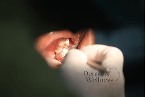Guide to Wisdom Tooth Extraction and Recovery