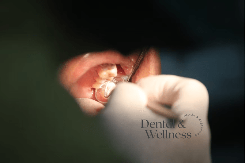 Guide to Wisdom Tooth Extraction and Recovery
