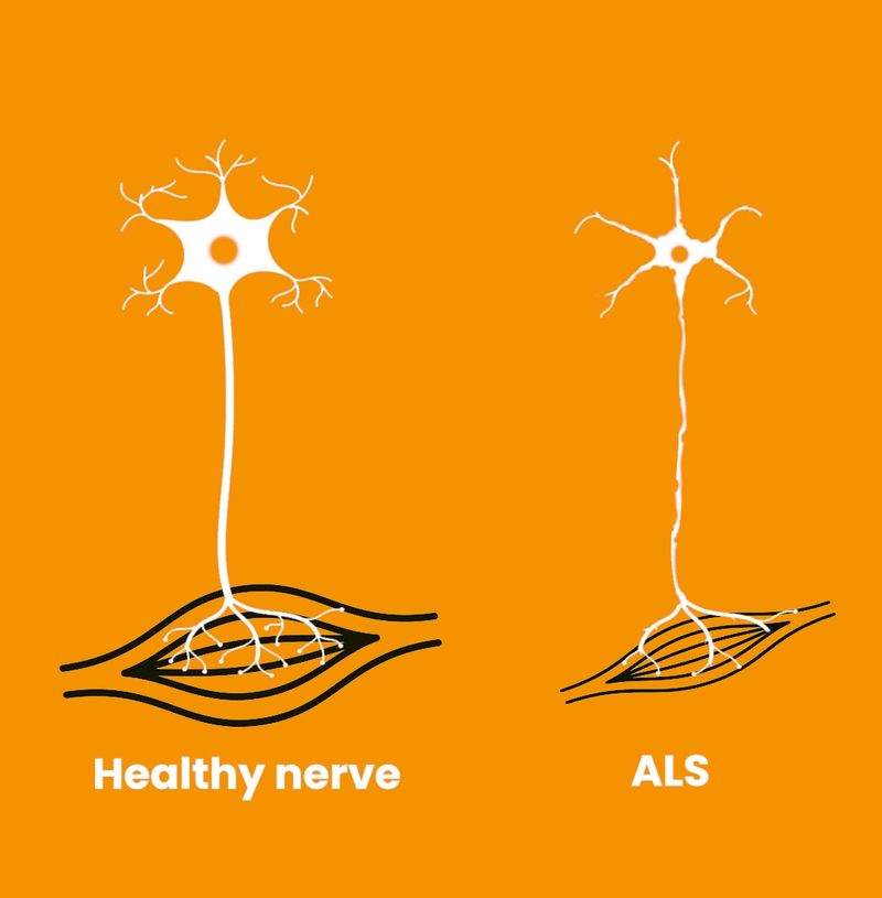 Living with ALS | Borje Salming ALS Foundation