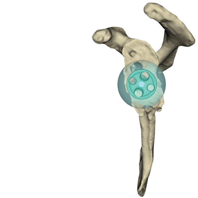 Planning with Blueprint® | Stryker