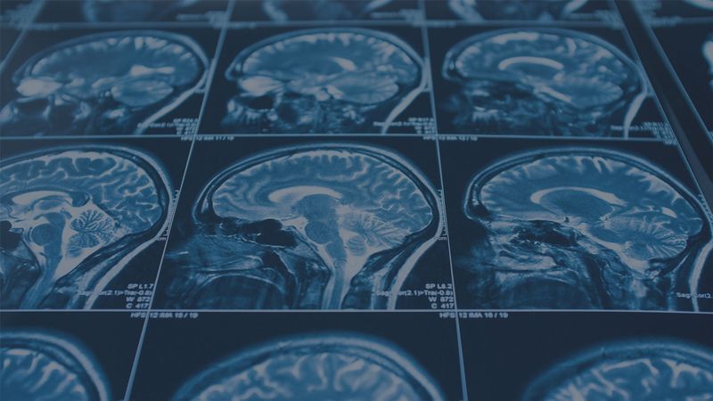 Exploring MRI with AI as a Preventative Diagnostics Tool