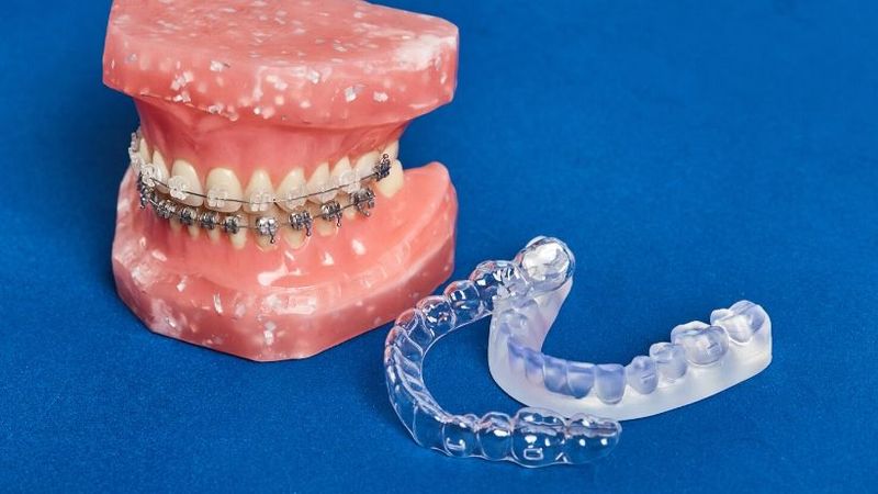 All Your Teeth Straightening Options Explained