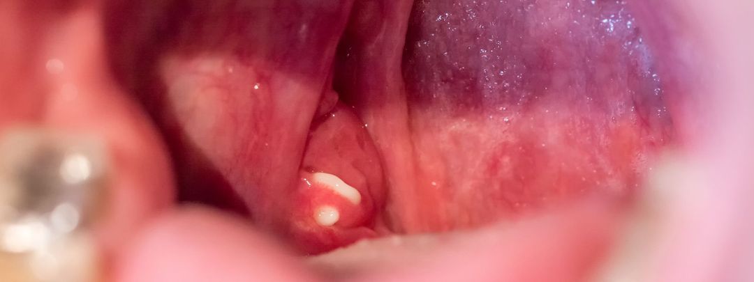 Cryptic Tonsils: Causes, Symptoms and Treatment