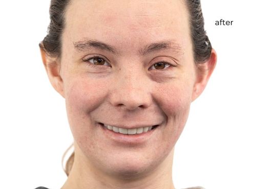 Your Guide to Zirconia Teeth and How to Get Them in 24 Hours