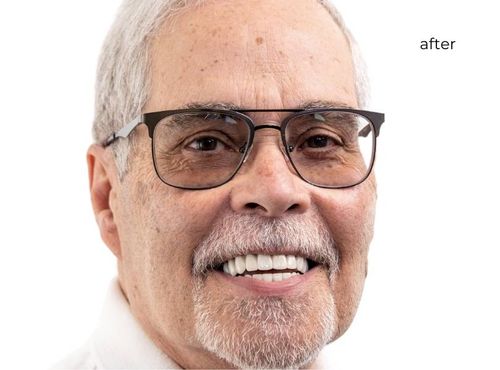 Full Mouth Dental Implants: See if You Might Qualify