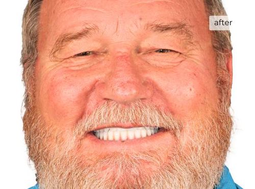 Permanent Teeth in 24 Hours From Nuvia Dental Implant Center