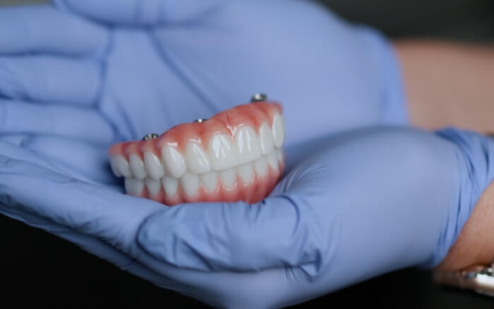 24-Hour Permanent Teeth with Dental Implants in Dallas